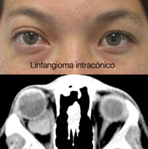 Tumores Orbitrarios - Dr. Marco Sales